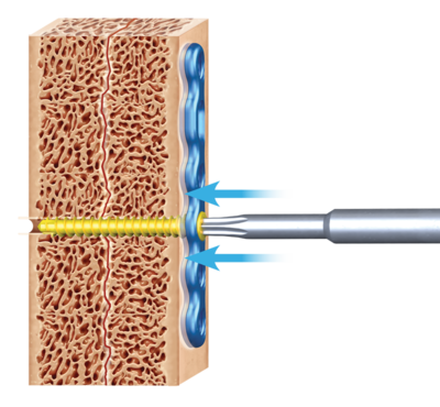 Arthrex - KreuLock™ Locking Compression Screws
