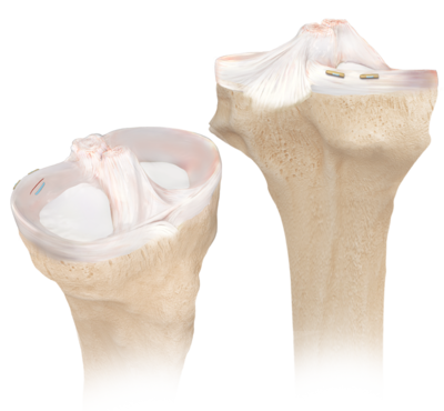 Arthrex - Meniscal Cinch™ II Technique