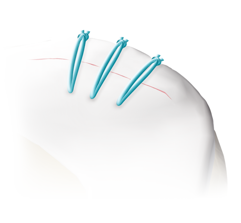 Arthrex - Meniscal Viper™