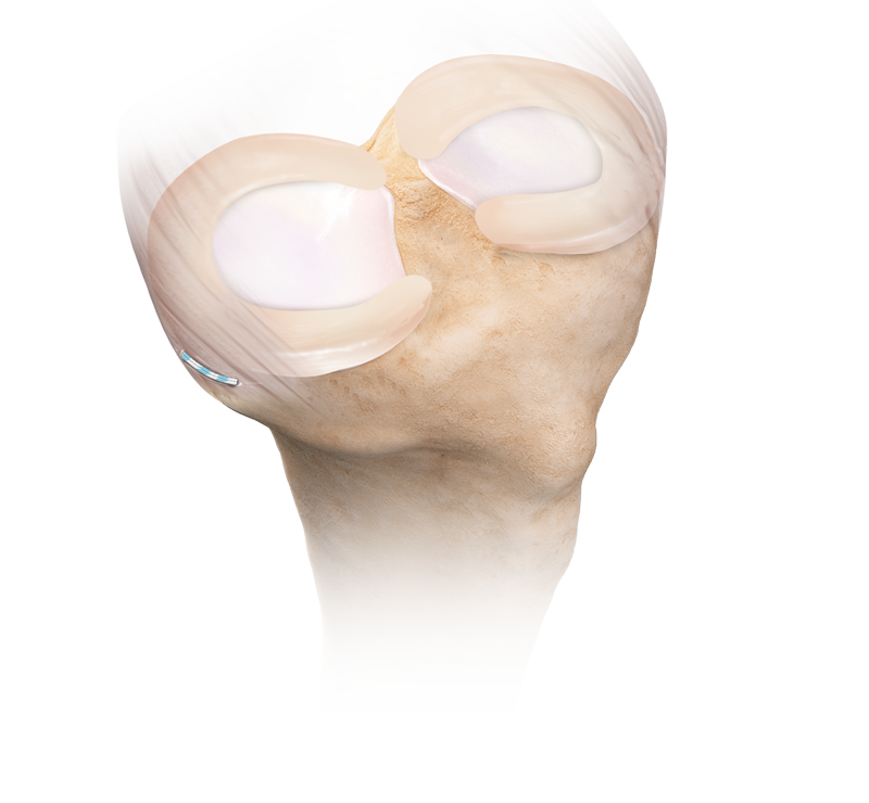 Arthrex - Extrusão do menisco