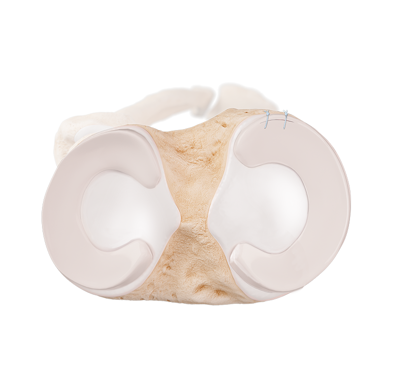 Arthrex - Meniscus Ramp Lesion