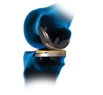 Arthrex - Partial Knee Resurfacing