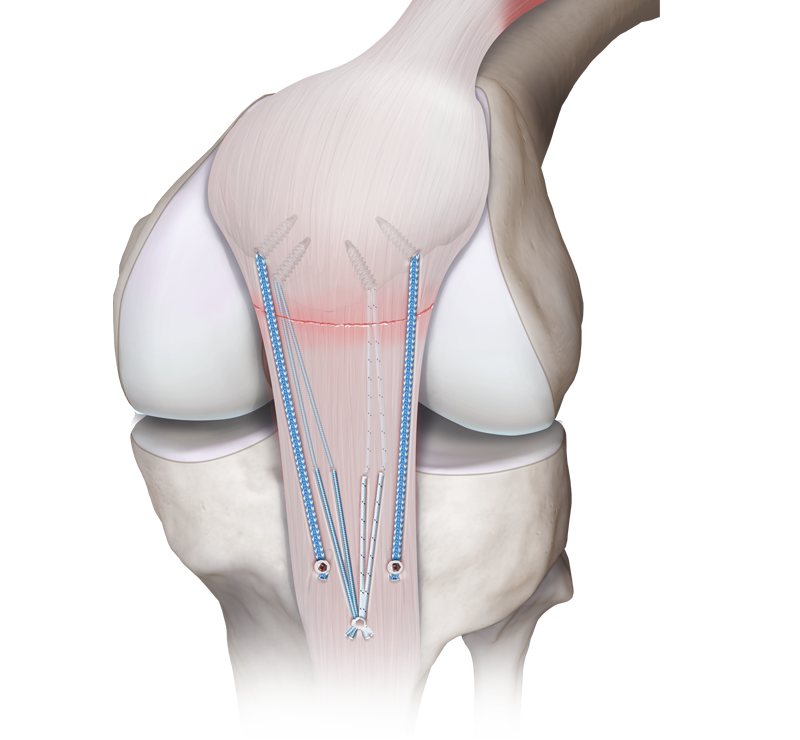 Arthrex Patellar Tendon Repair