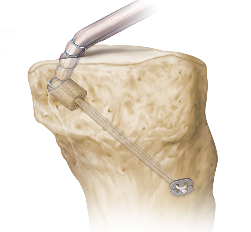 Arthrex - Fijación de injerto de HTH para LCP