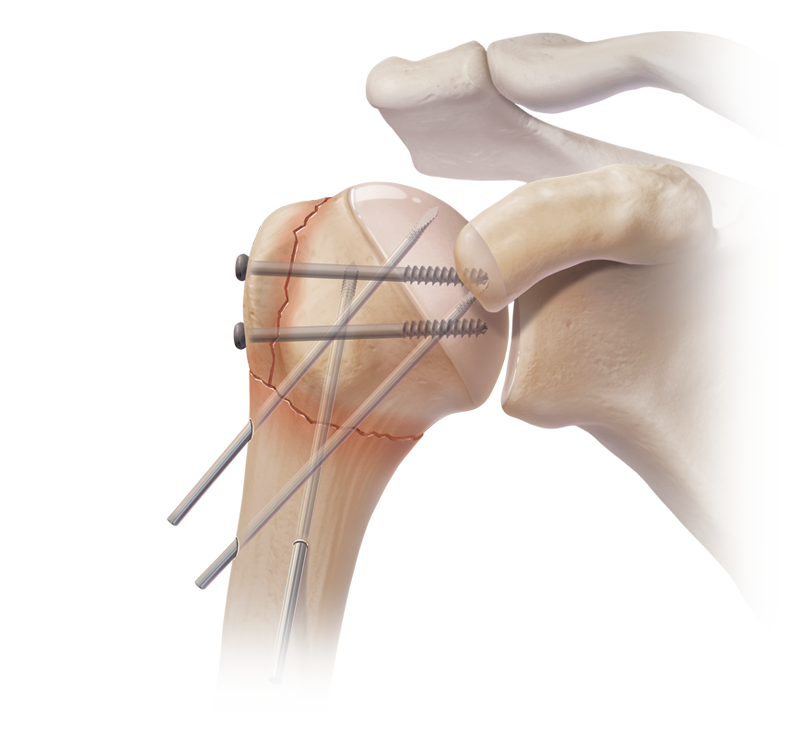Arthrex Percutaneous Pinning Technique