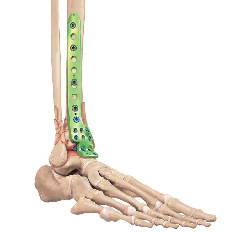 Arthrex - Pilon Fusion Plating System