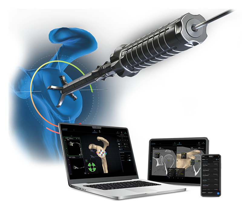 Arthrex - Virtual Implant Positioning™ (VIP™) System