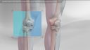 Arthrex - Meniscal Root Repair Technique