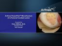Arthrex - Arthrex PowerPick™ Microfracture of a Femoral Condyle Lesion