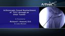 Arthrex - Arthroscopic Foveal Reattachment of TFCC through an Ulnar Tunnel