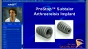 Arthrex - ProStop® Arthroeresis