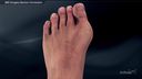 Arthrex - MIS Surgery Bunion Correction