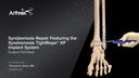Arthrex - Syndesmosis TightRope® XP Implant System