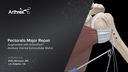 Arthrex - Pectoralis Major Repair Augmented with ArthroFlex® Acellular ...
