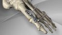 Arthrex - Interphalangeal Joint Fusion