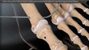 Arthrex - Forefoot InternalBrace™ Ligament Augmentation Repair Implant ...