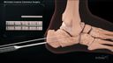 Arthrex - Minimally Invasive Calcaneus Surgery