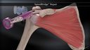 Arthrex - Knotted Rotator Cuff Repair