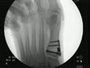 Arthrex - Proximal 1st Metatarsal Osteotomy