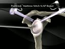 Arthrex - PushLock® Mattress Stitch SLAP Repair