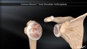 Arthrex - Univers Revers™ Total Shoulder Arthroplasty