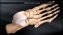Arthrex - Jones Fracture Repair